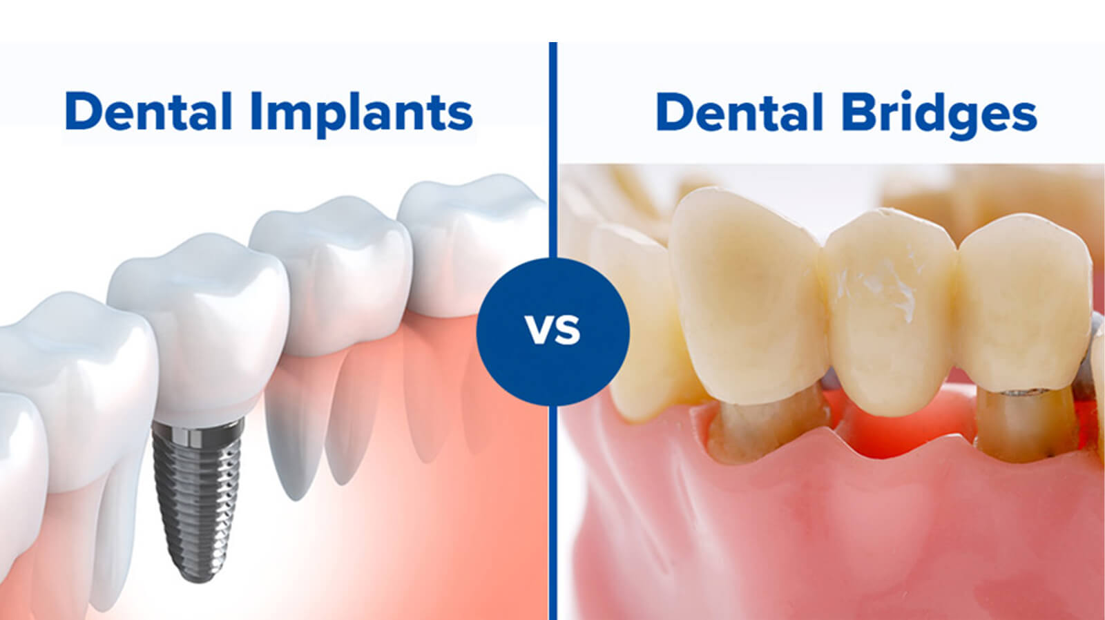 Dental Implants vs. Bridges: Which One Should You Choose? – Arya Dental